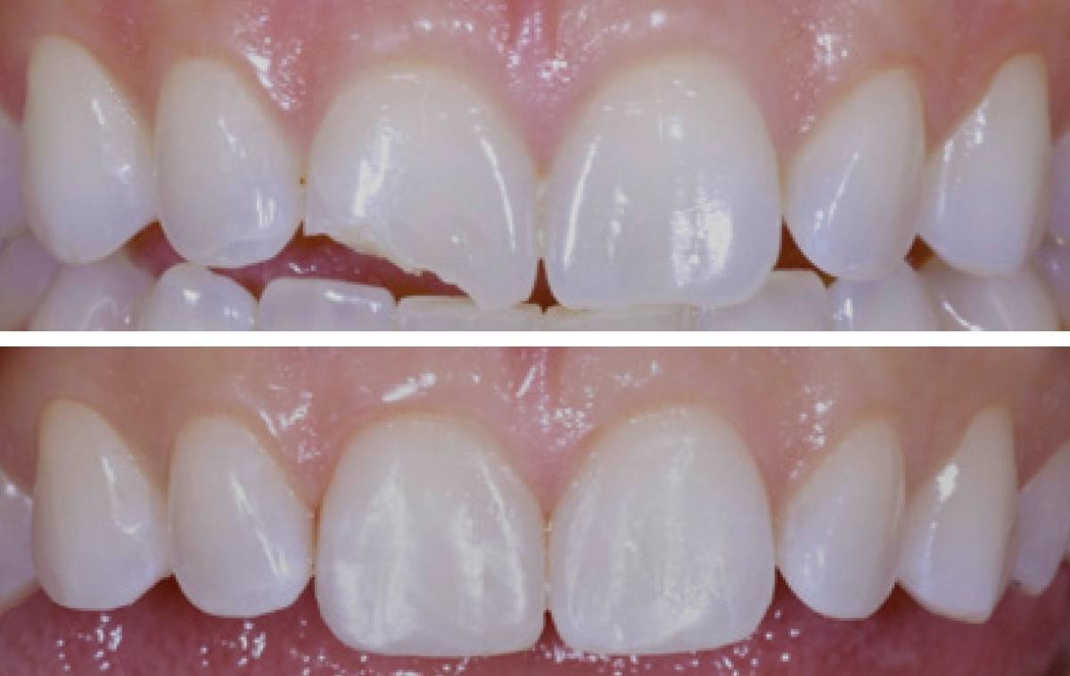 Tooth Restoration – Surana Dental Care